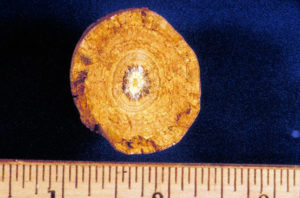 Kidney Stone Photos – StoneDisease.org