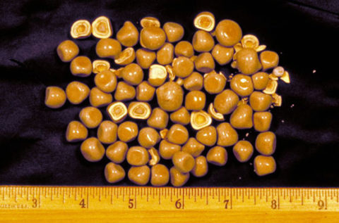 Calcium Oxalate Kidney Stones – StoneDisease.org